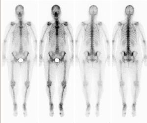 Knochenszintigraphie | Nuklearmedizin